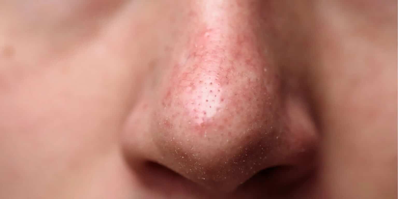 Alcoholic Nose: Causes, Symptoms, And Treatment Options